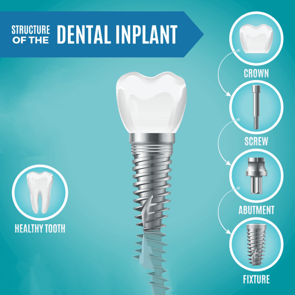 Components of Your Dental Implant - Dentist in Ellicott City, MD